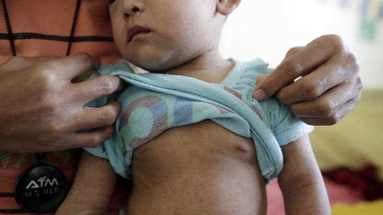 A measles warning has been issued. Here's how to protect yourself | SBS ...
